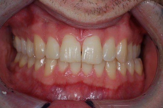 Zahnfleischentzündung - Ursache und Behandlung